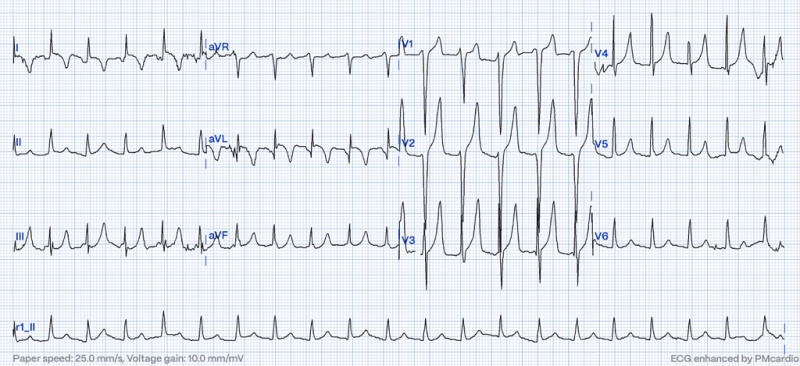 Hyperkalemia EKG Changes vs. Normal ECG: Critical Differences You ...