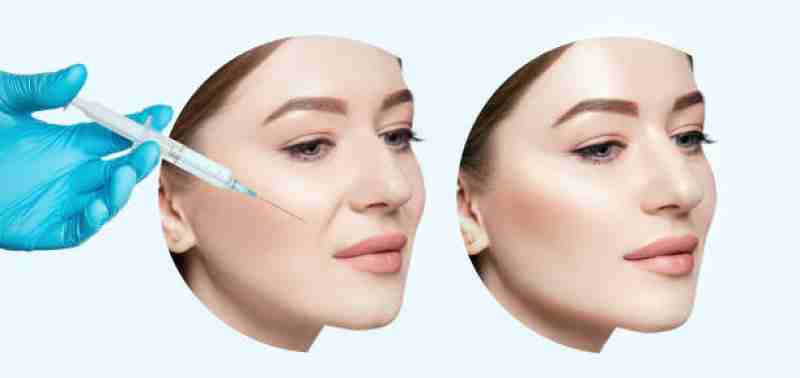 Korean Botox: Safe, Effective & Affordable Anti-Aging Treatment