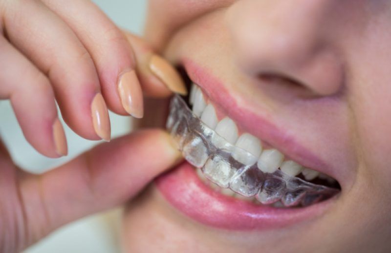 Best Colors for Teeth Braces: Tips for a Personal Touch | The Wireworks