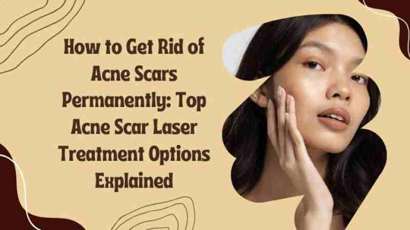 How to Get Rid of Acne Scars Permanently: Top Acne Scar Laser Treatment ...