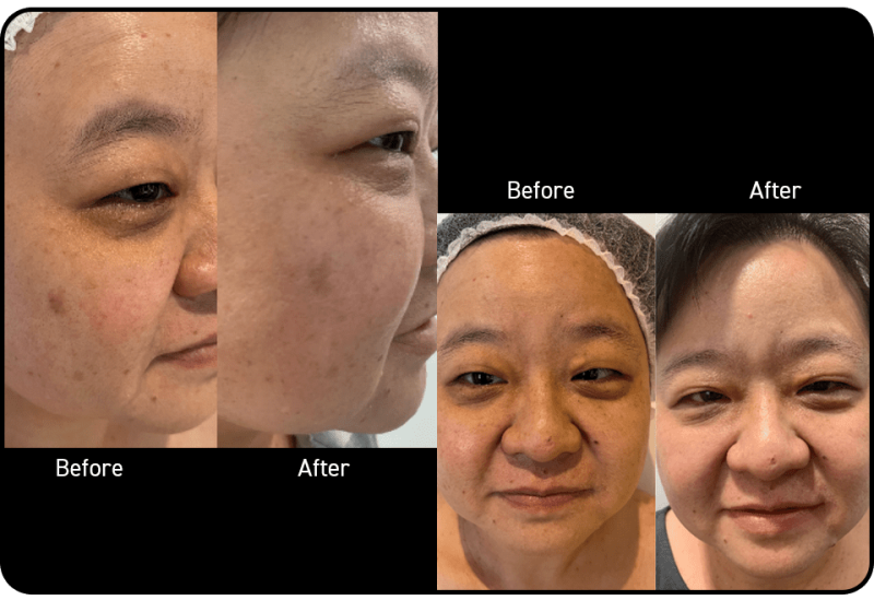 Botox for Excessive Sweating: What to Expect