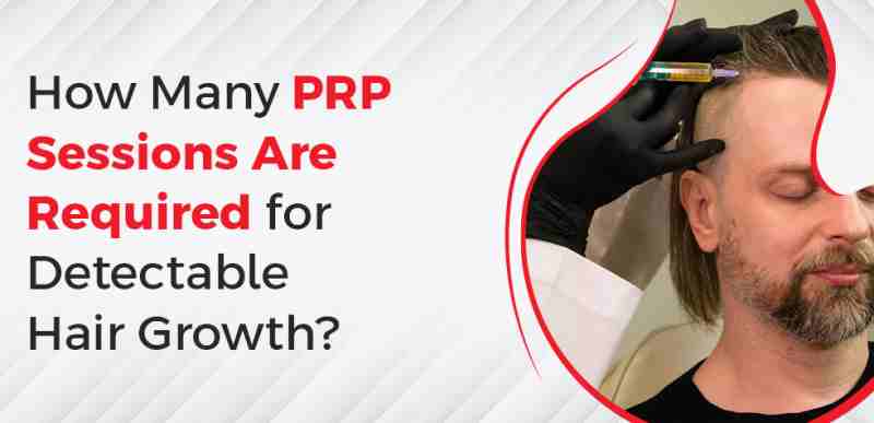 How Many PRP Sessions Are Required for Detectable Hair Growth?